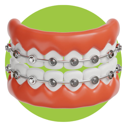 Braces That Fit Your Budget - Somos Dental, Dallas